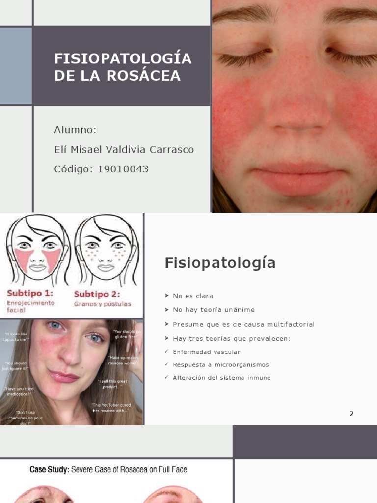 Fisiopatología de la rosácea | PDF | Condiciones cutáneas | Epidemiología