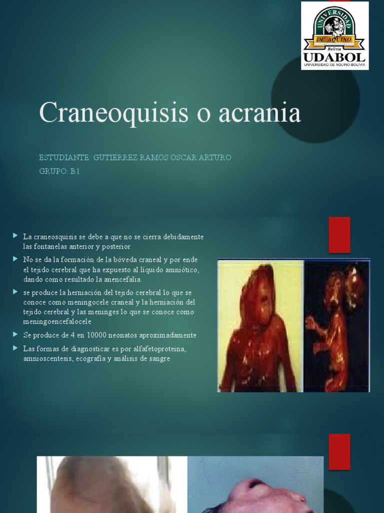 Craneoquisis o Acrania | PDF