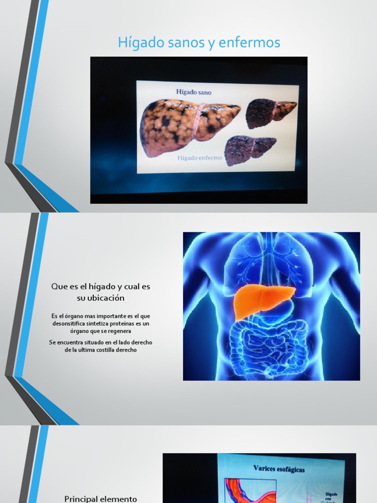 Higado Sano y Enfermos | PDF | Hígado | Cirrosis