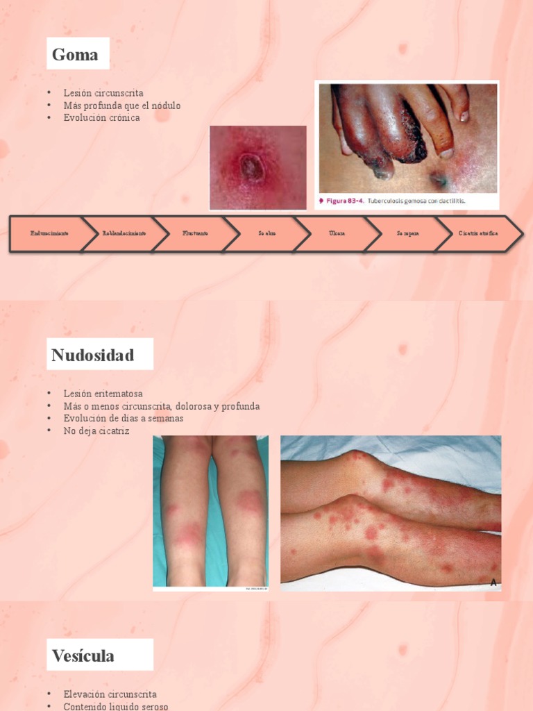 Goma y Nódulos: Características y Lesiones | PDF | Epidermis | Inflamación