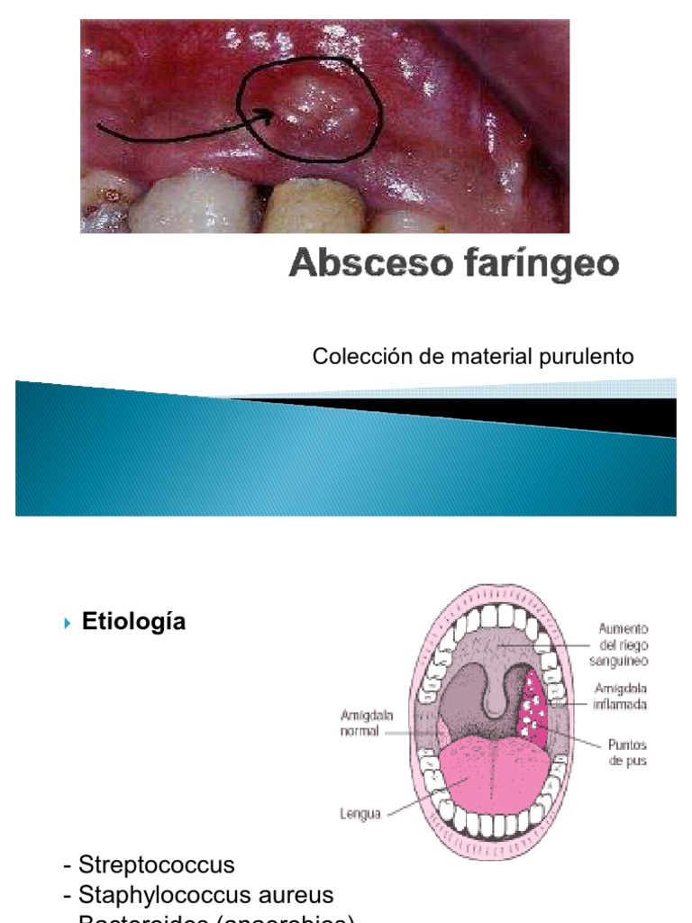 Absceso Faringeo | PDF | Ciencia y matemáticas