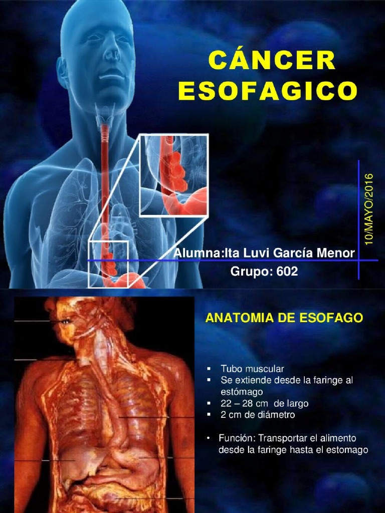 Cáncer de Esofago | PDF