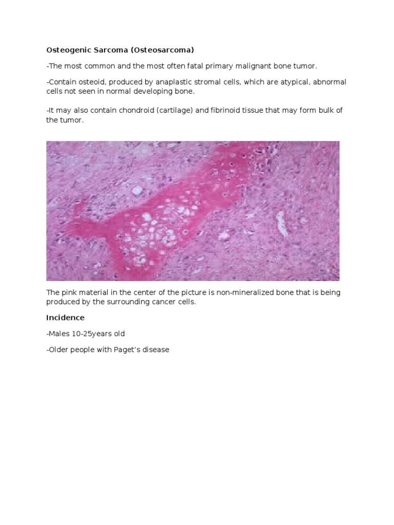 Osteosarcoma | Bone | Metastasis
