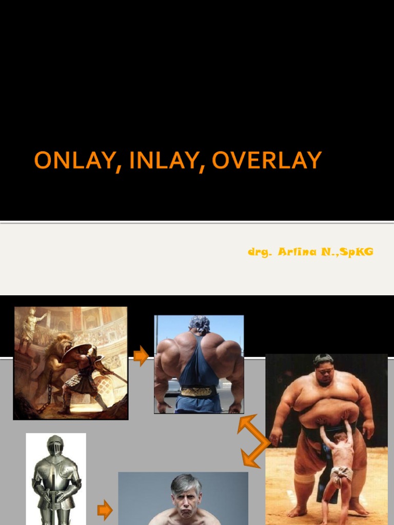 Onlay, Inlay, Overlay Edisi 4 2010 | PDF