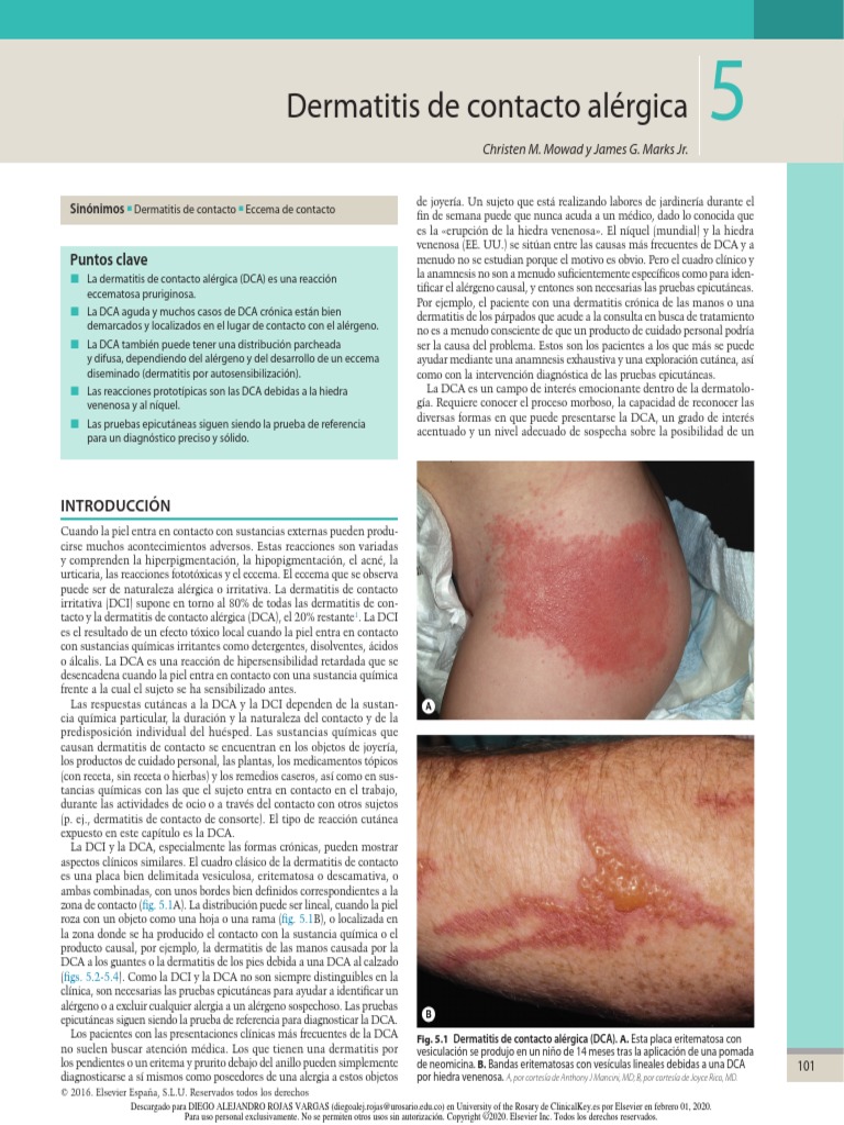 Dermatitis Contacto Alérgica | PDF | Alergia | Especialidades Medicas