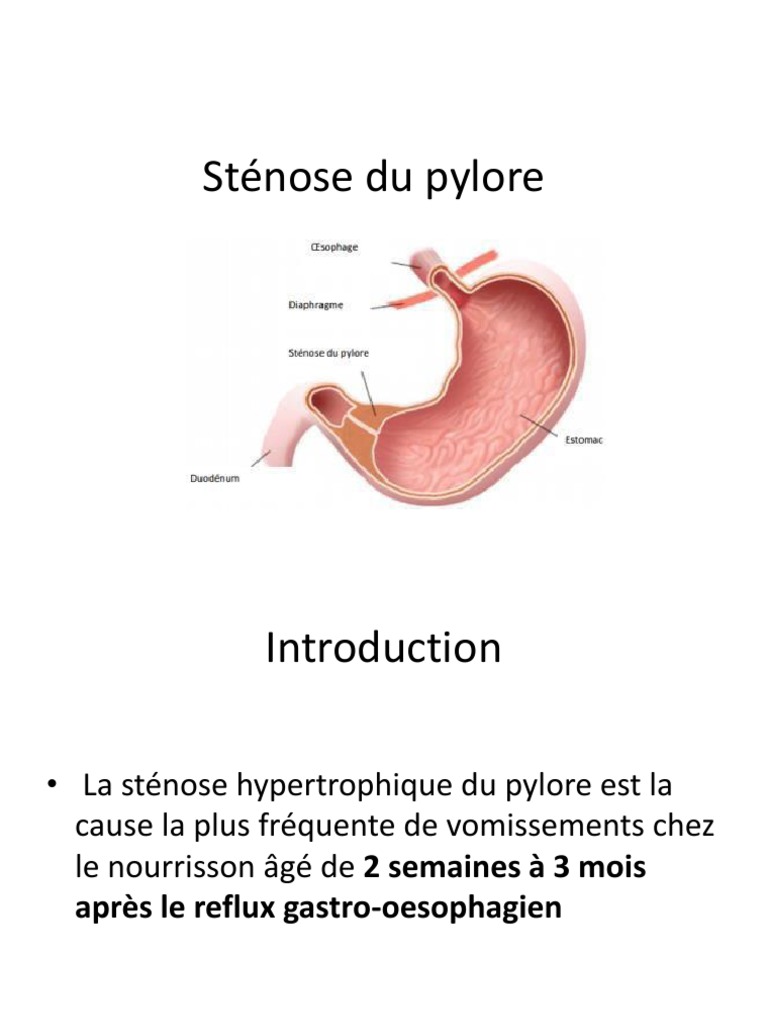 Sténose Du Pylore | PDF | Livres de cuisine, nourriture et vin | Bien-être