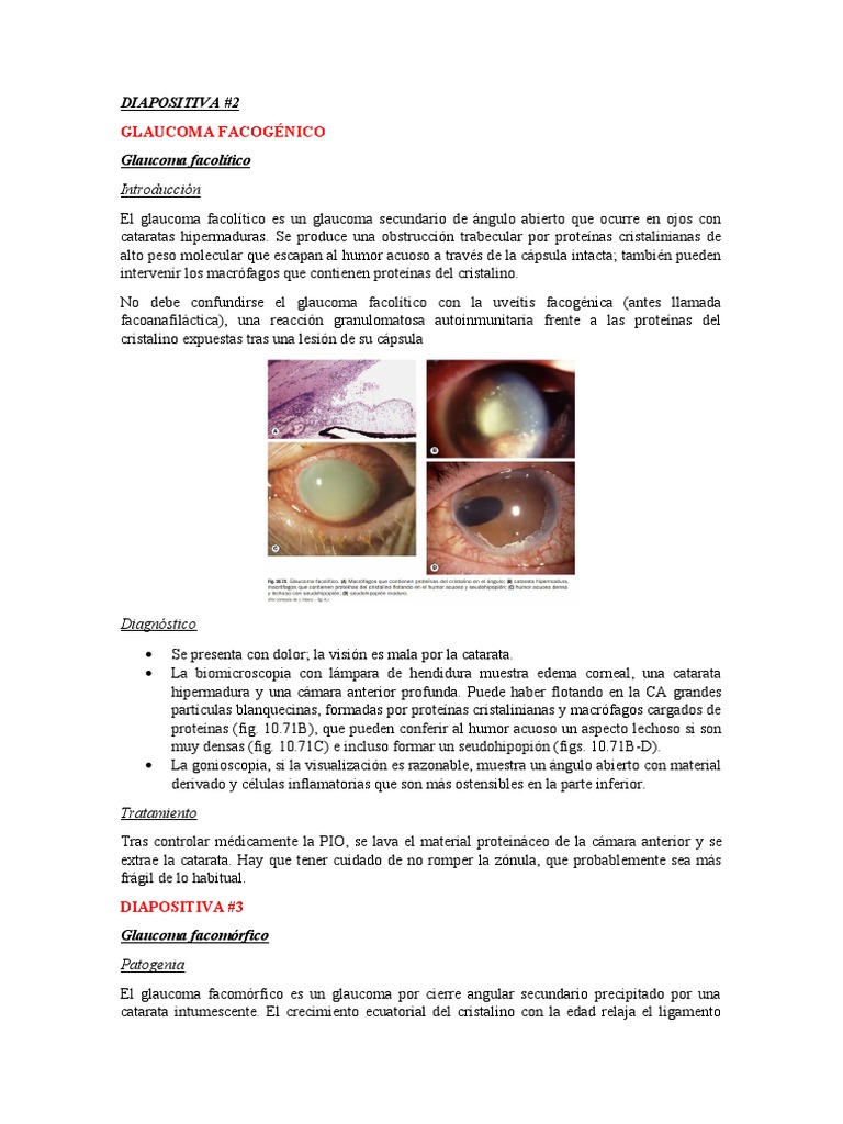 Exposicion Oftalmologia | PDF | Glaucoma | Ojo humano