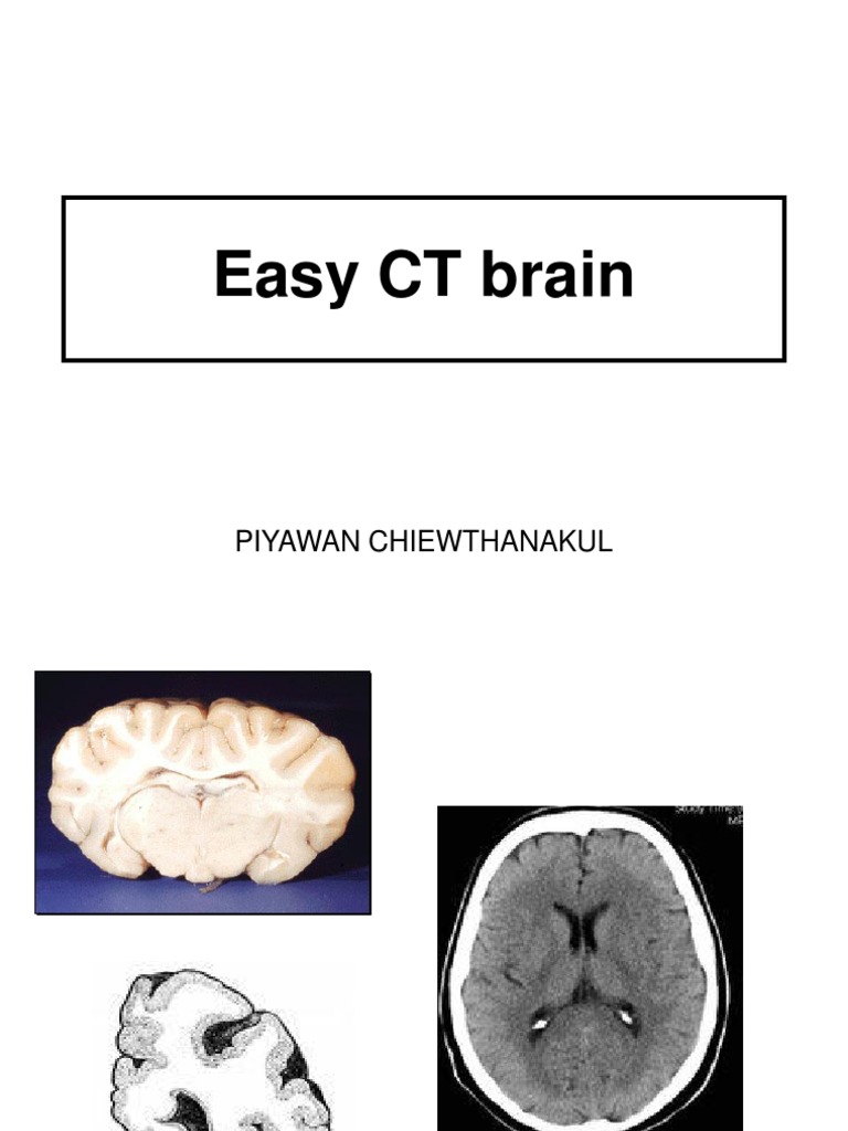 Basic CT | PDF | Cerebral Cortex | Human Brain