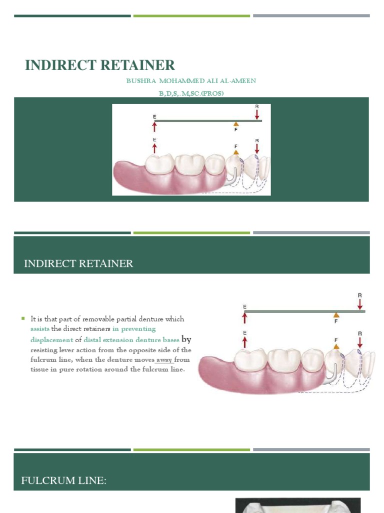13) Indirect Retainer | PDF | Dentures | Tooth