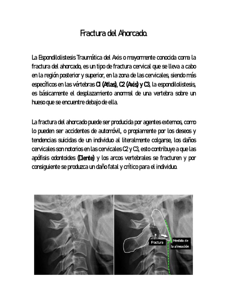 Fractura Del Ahorcado | PDF