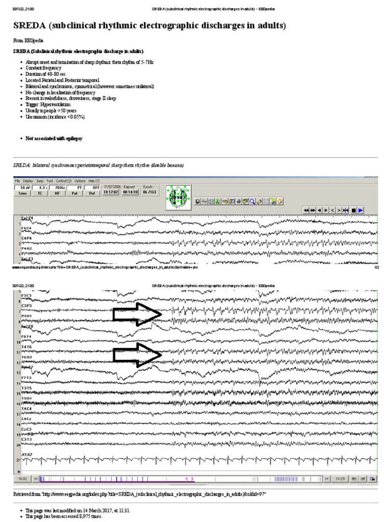 SREDA (Subclinical Rhythmic Electrographic Discharges in Adults ...