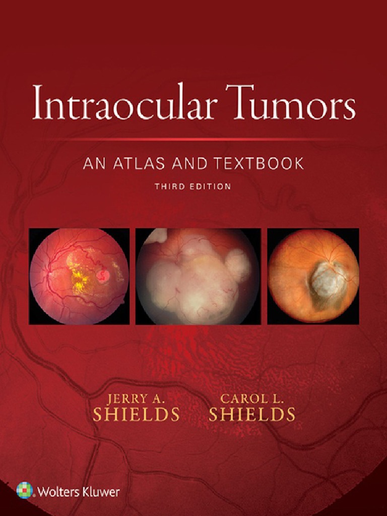 Intraocular Tumors An Atlas and Textbook | PDF | Melanoma | Adenoma