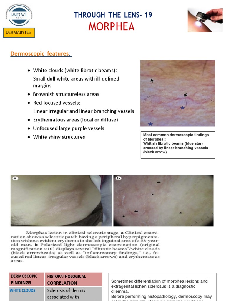 Dermoscopy of Morphea | PDF