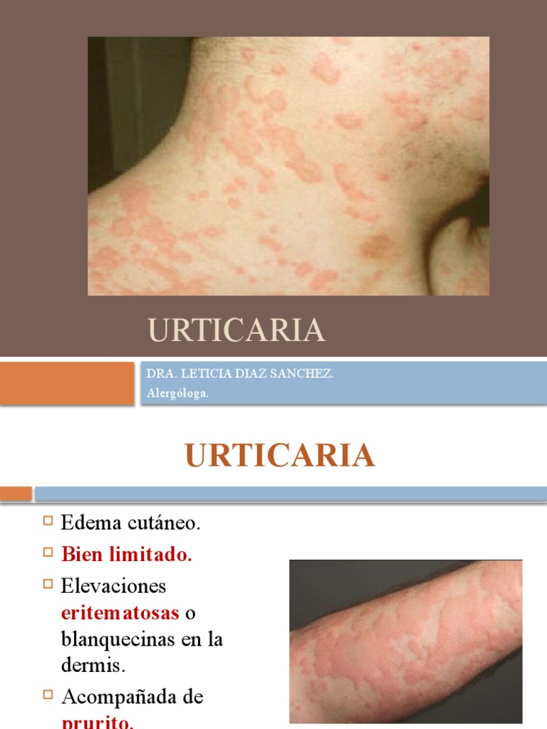 Comprensión integral de la urticaria: clasificación, causas, diagnóstico y tratamiento | PDF ...