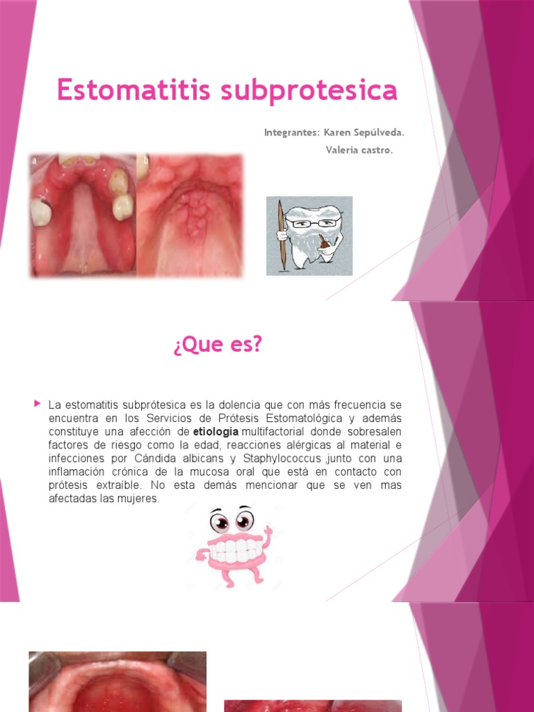 Estomatitis Subprotesica 2 | PDF | Dentadura postiza | Inflamación