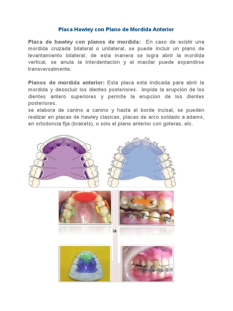 Placa Hawley Con Plano de Mordida Anterior | PDF