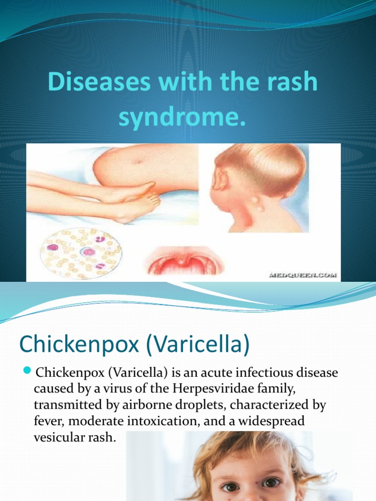 Diseases With The Rash Syndrome11. | PDF | Measles | Infection