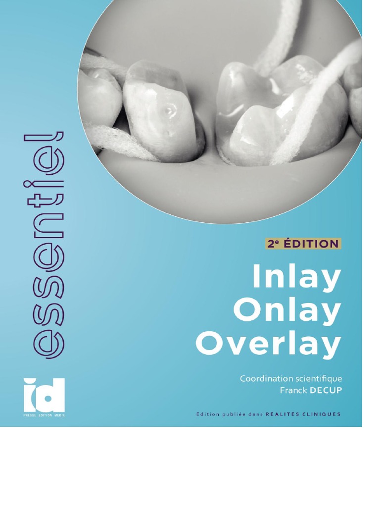 Inlay Onlay Overlay | PDF