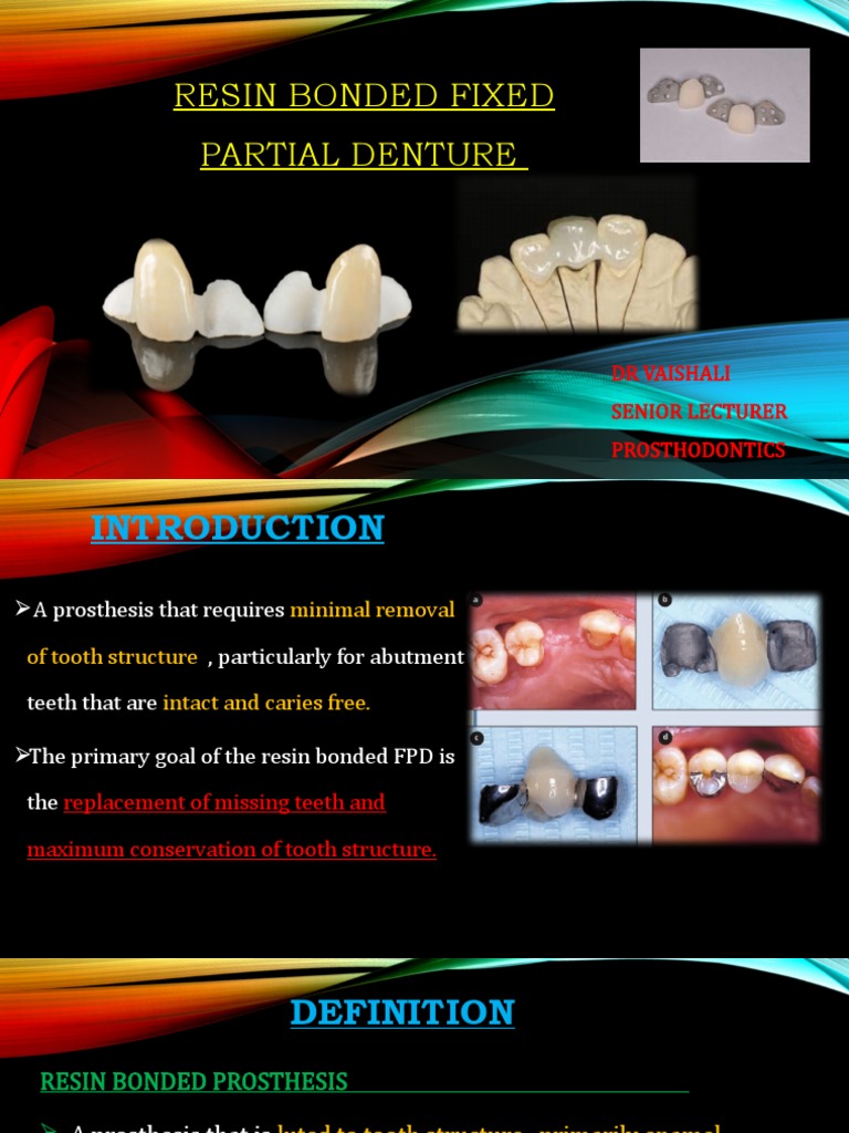Resin Bonded FPD | PDF | Dentistry Branches