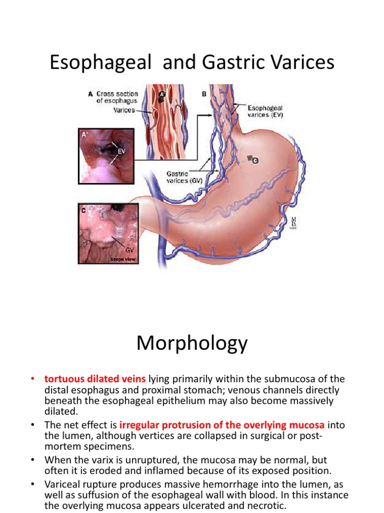 Esophageal And Gastric Varices Cirrhosis Medical Specialties