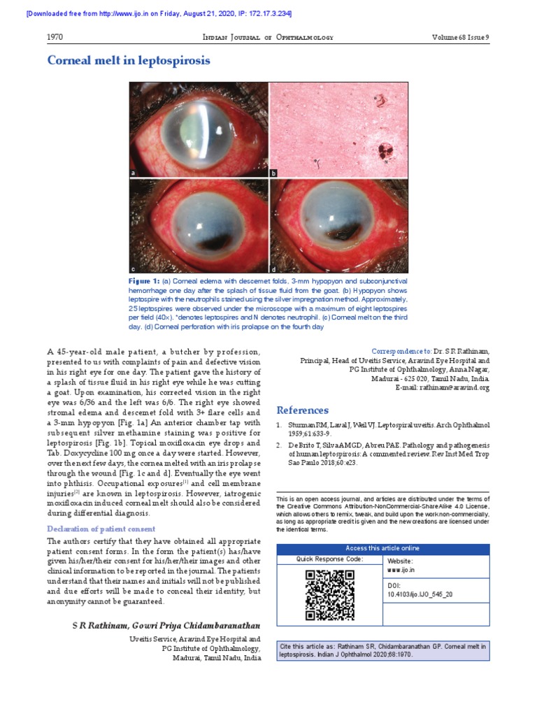 Corneal Melt in Leptospirosis | PDF | Diseases And Disorders | Eye