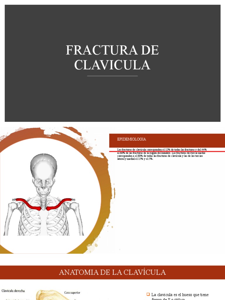 Fractura de Clavicula | PDF | Hombro | Anatomía