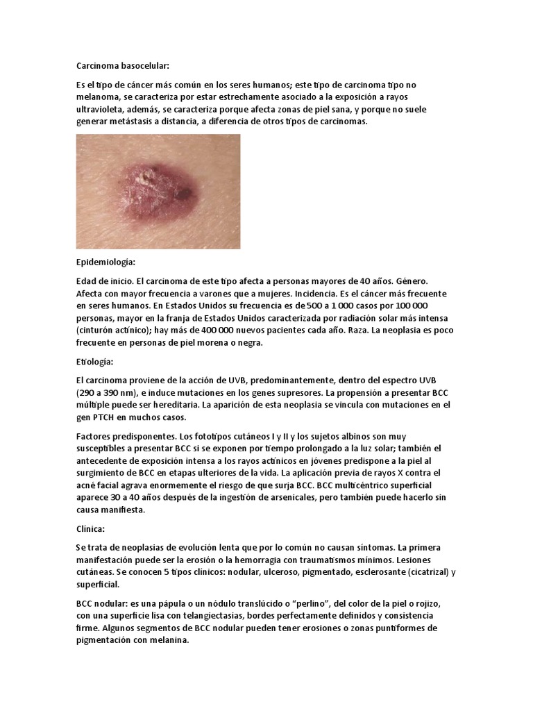 Carcinoma Basocelular | PDF | Cáncer | Medicina CLINICA
