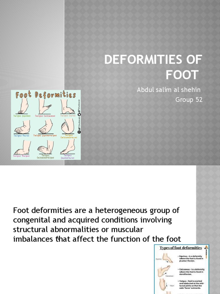 Deformities of Foot | Download Free PDF | Foot | Lower Limb Anatomy