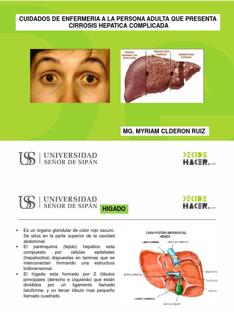 Cirrosis Hepatica | PDF | Cirrosis | Hígado