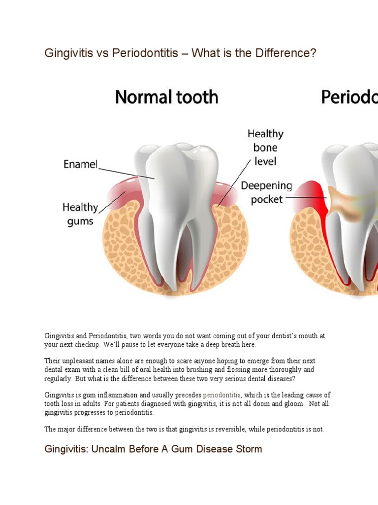 Gingivitis Vs Periodontitis | PDF | Dentistry Branches | Causes Of Death