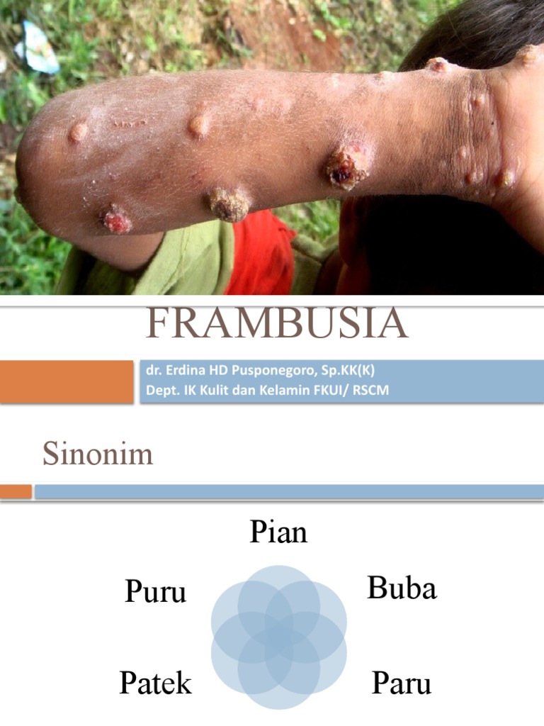 Penyuluhan Frambusia Pengajian | PDF