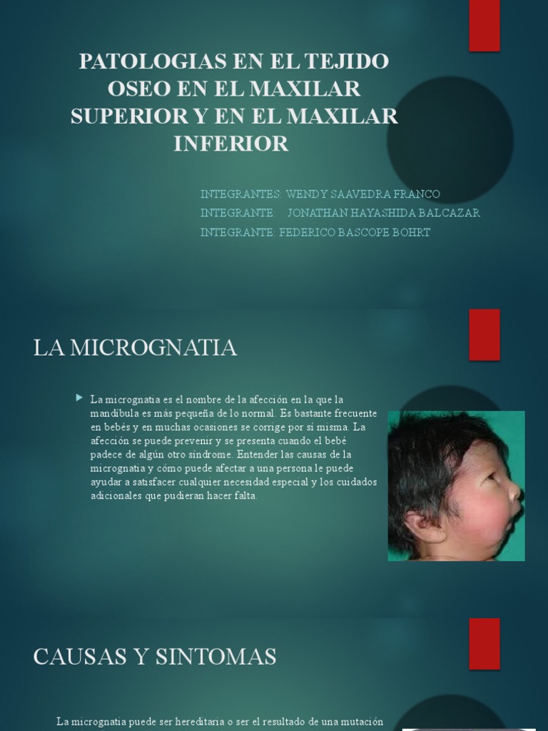 Micrognatia y Prognatismo Mandibular | PDF | Ortodoncia | Enfermedades ...