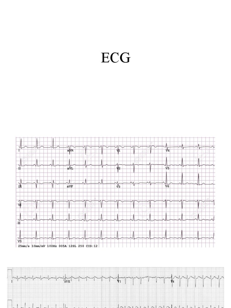 ECG Findings and Patient Management | PDF