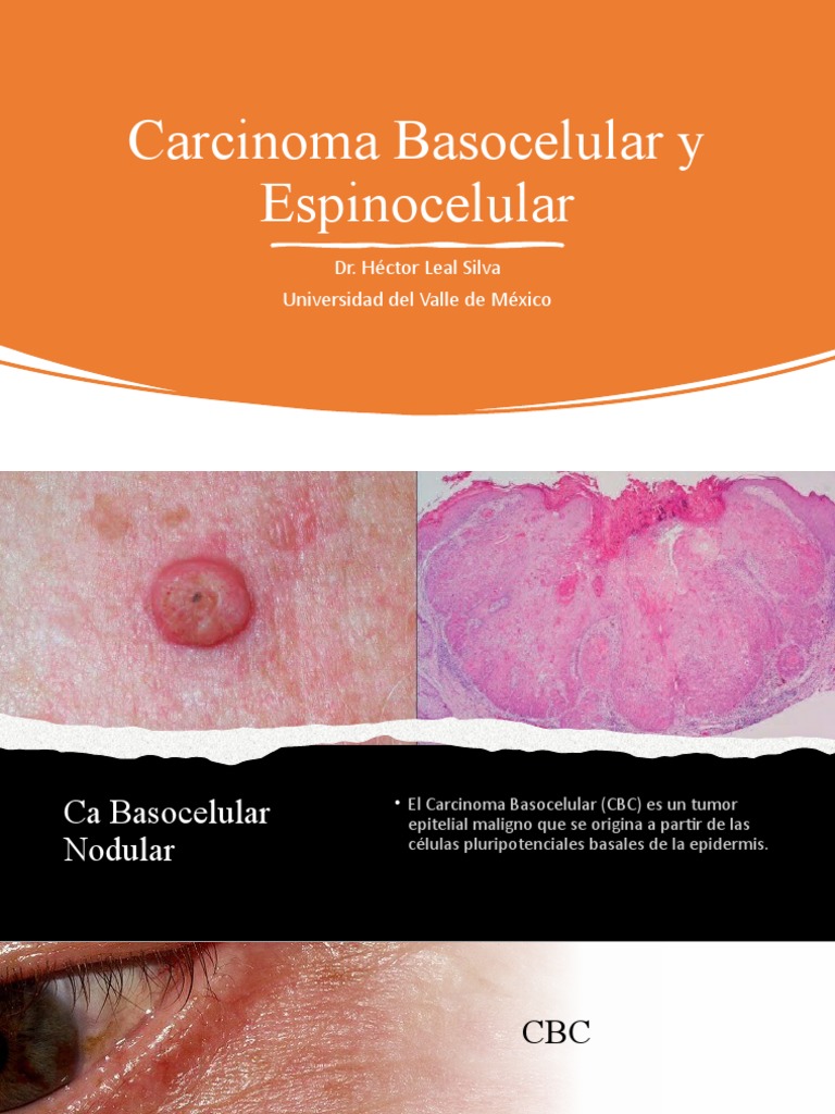Carcinoma Basocelular y Espinocelular | PDF | Cáncer | Metástasis