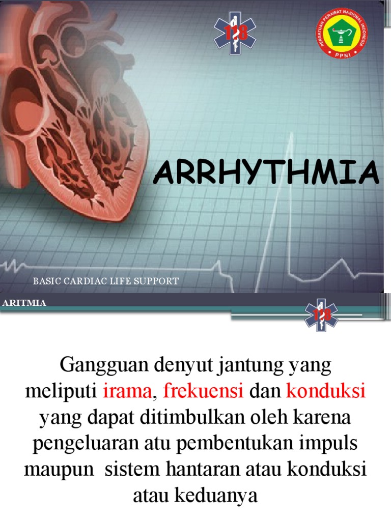 Cara Baca Ekg Aritmia Dodi | PDF