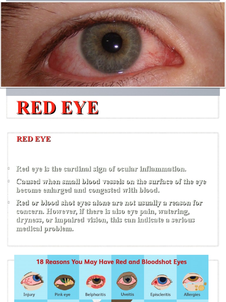 Red Eye | PDF | Glaucoma | Human Eye