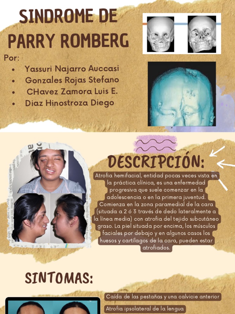 Sindrome de Parry Romberg | PDF | Medicina | Medicina CLINICA