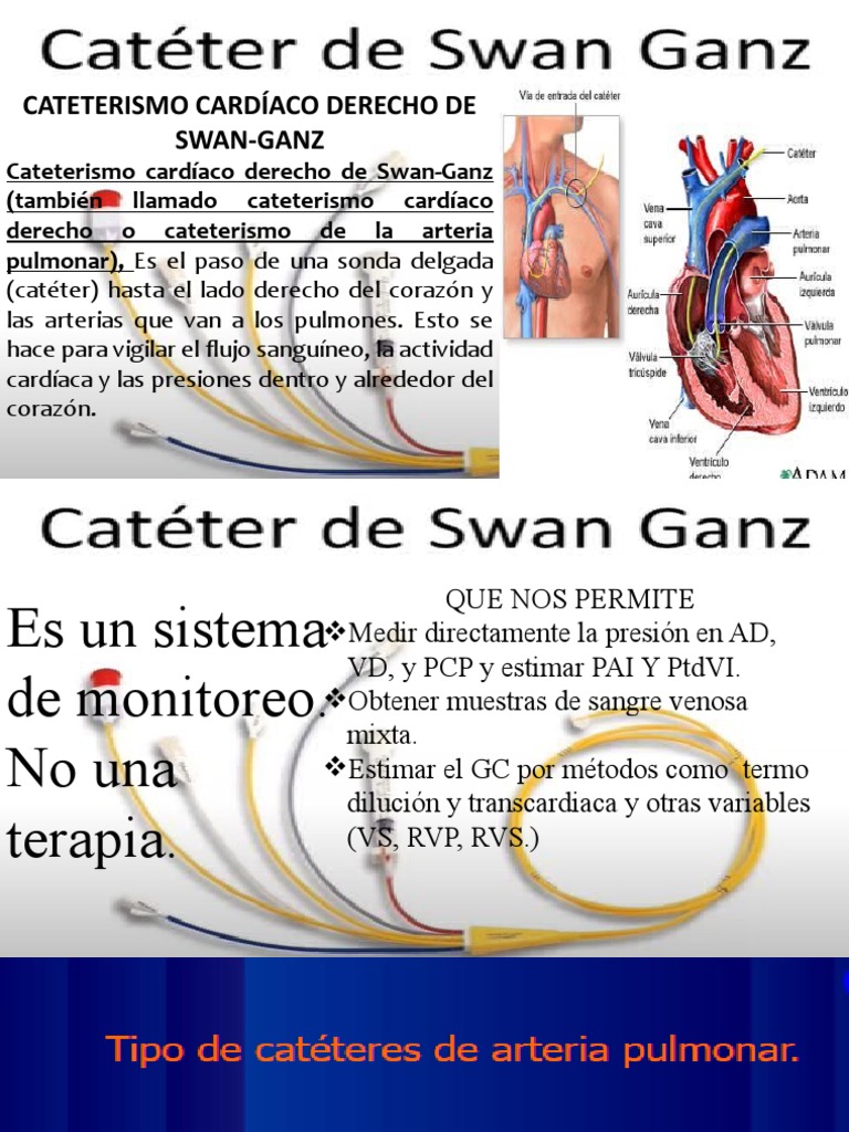 EXPOSICION Cateter Swan Ganz | PDF