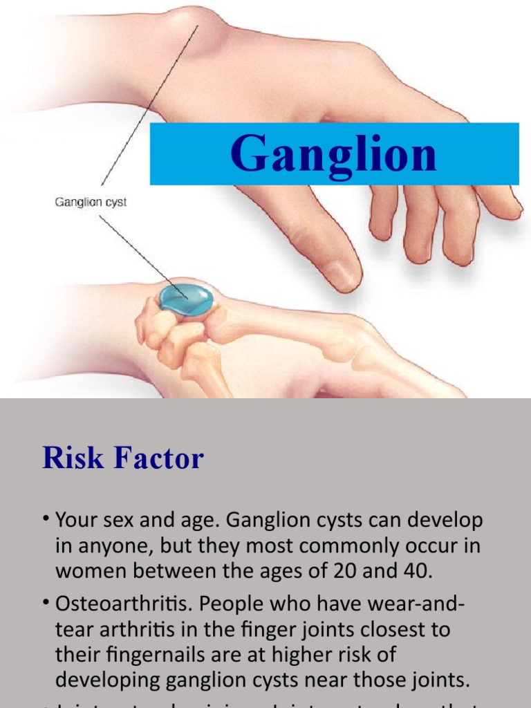 Ganglion | PDF | Surgery | Osteoarthritis