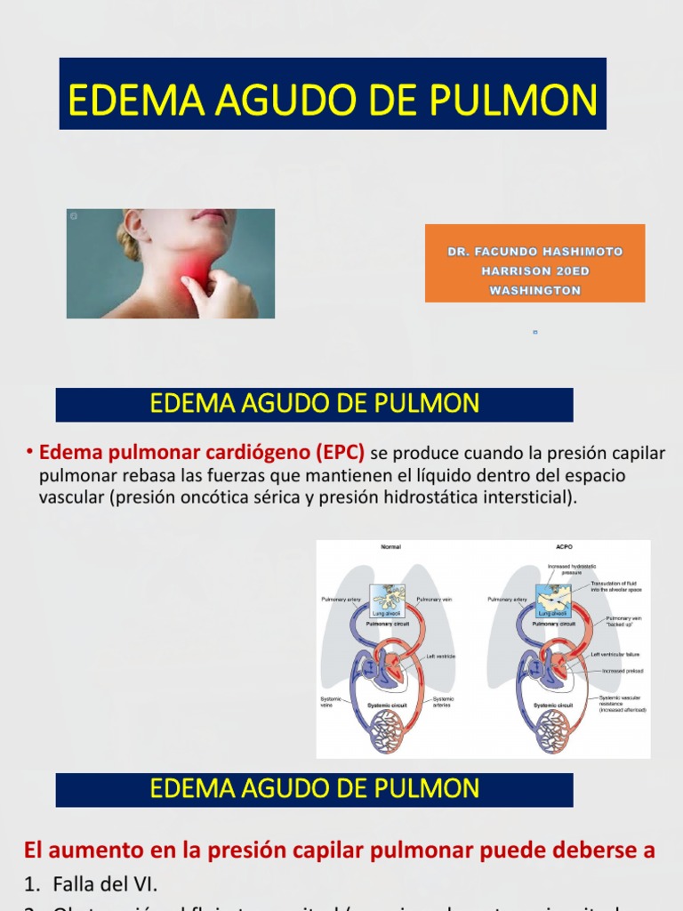 Edema Agudo de Pulmon | PDF | Edema | Pulmón