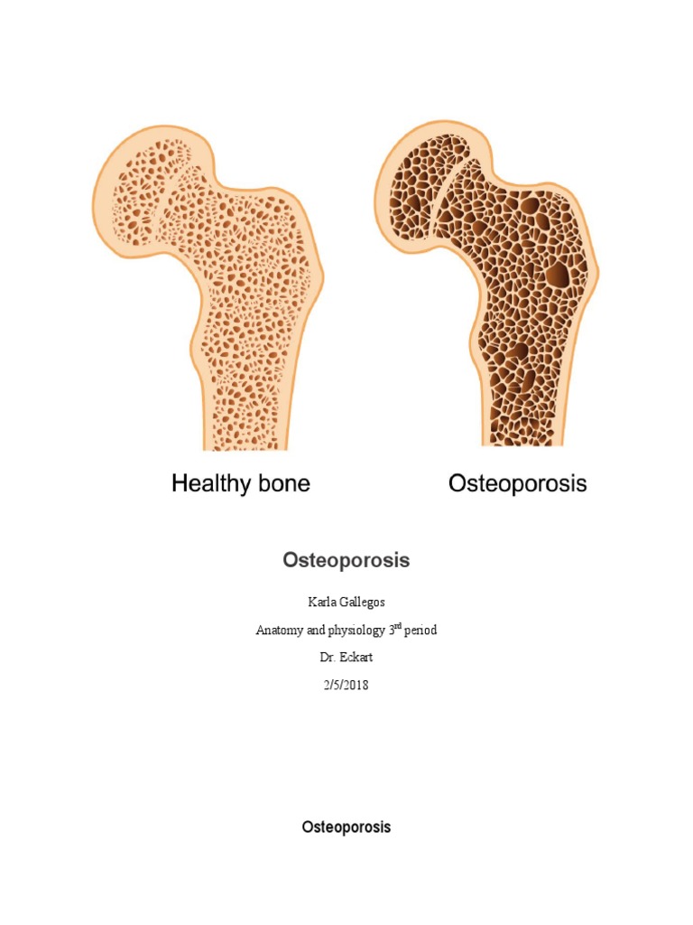Osteoporosis Pdf Osteoporosis Bone