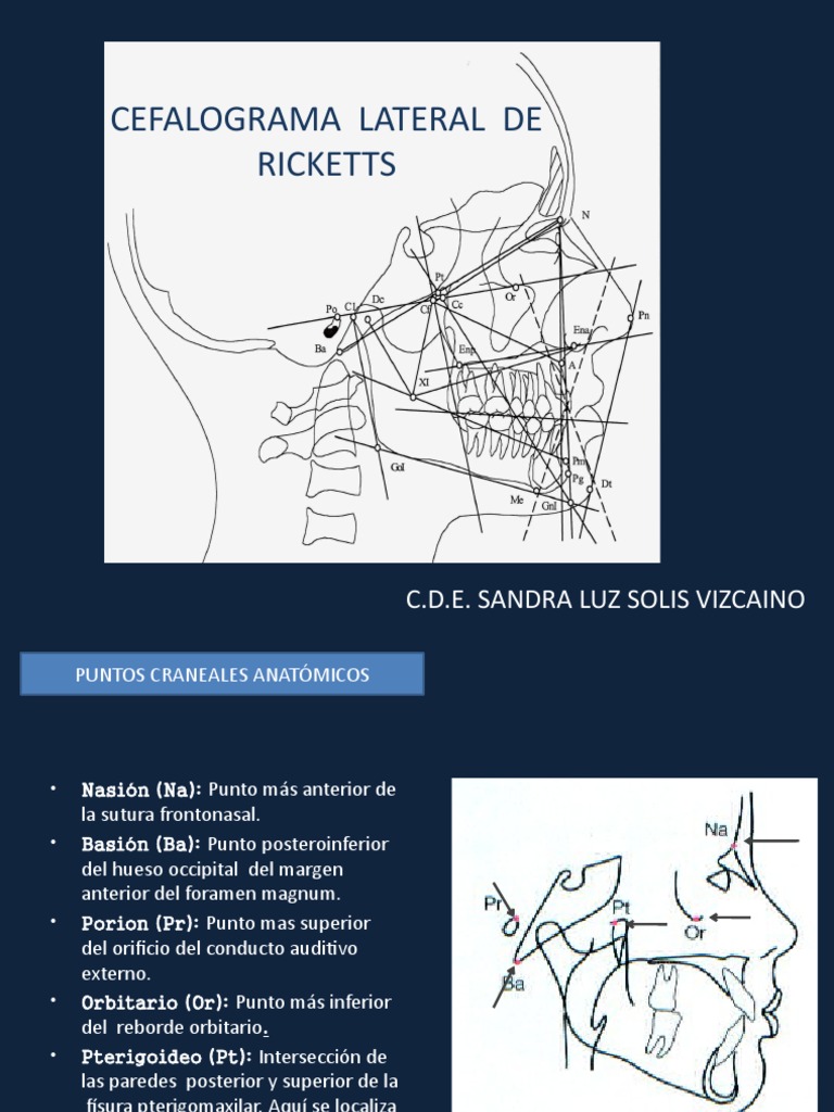 Análisis cefalométrico de los puntos anatómicos y planos utilizados en el estudio de Ricketts ...