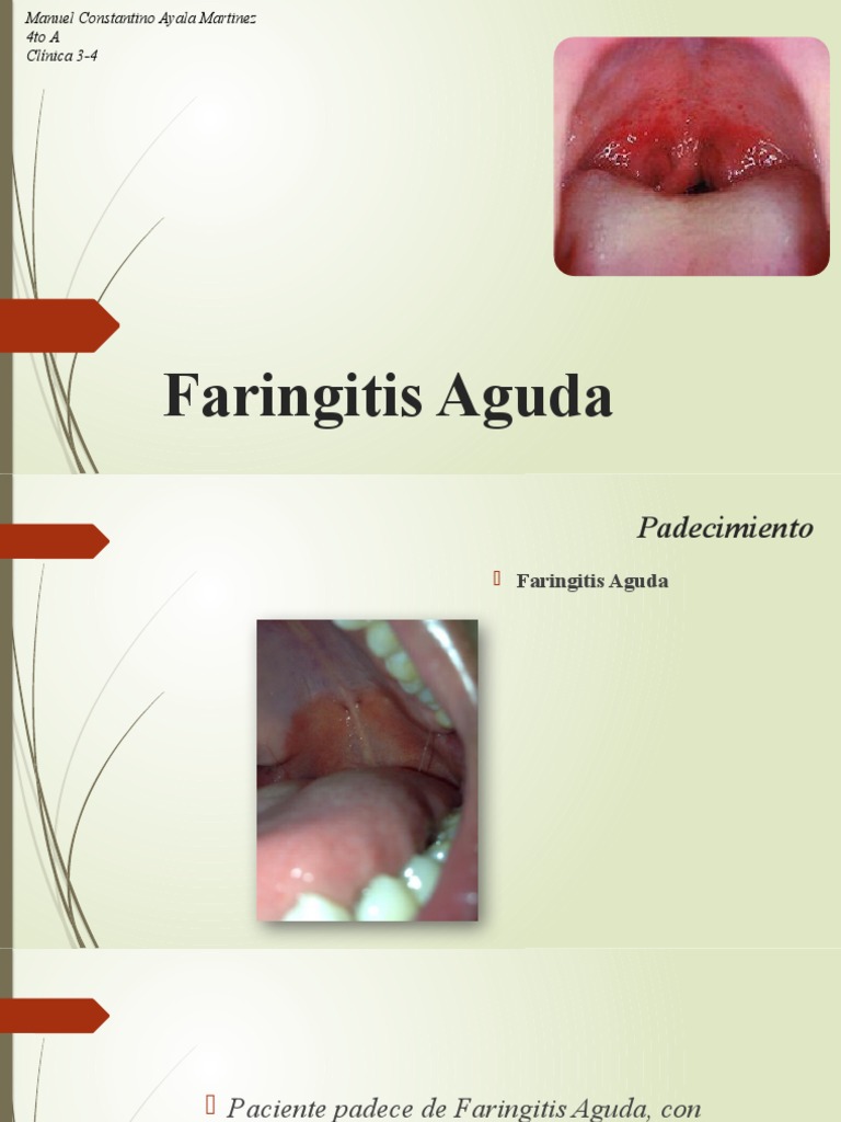 Faringitis Aguda: Síntomas y Tratamiento | PDF | Causas de la muerte ...