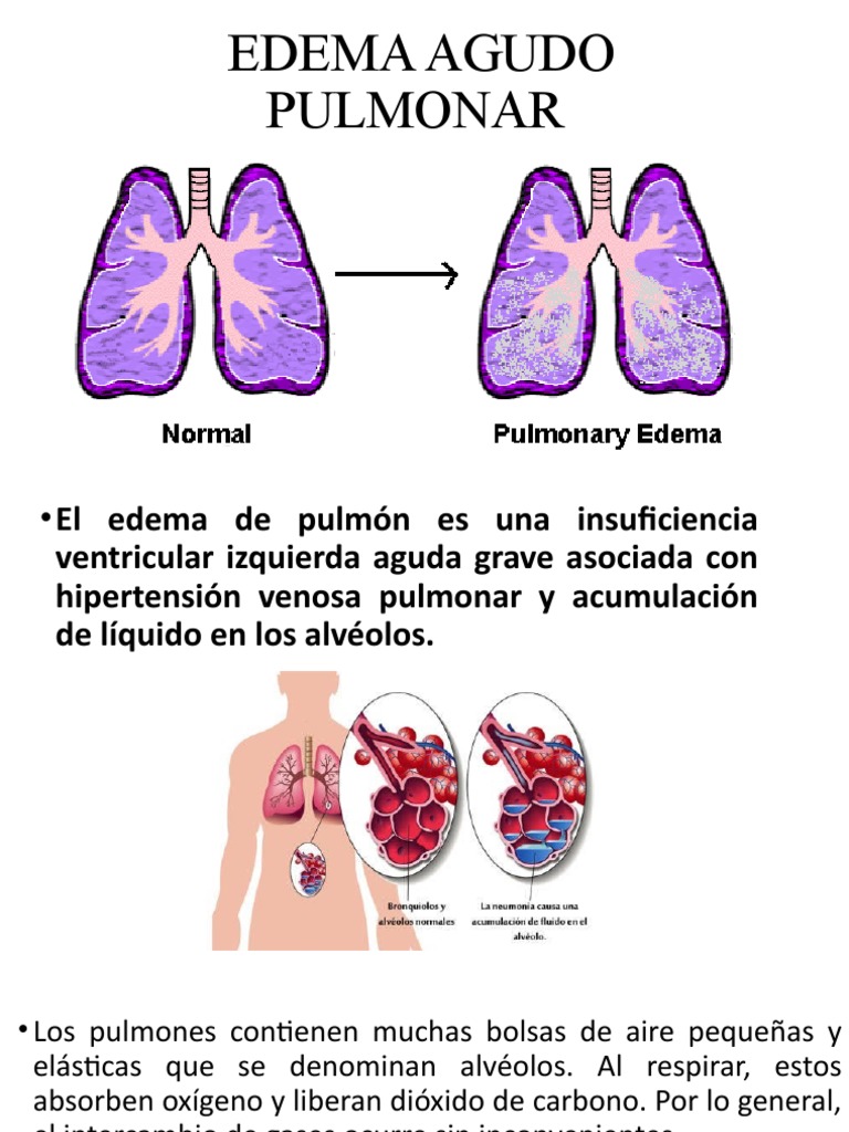 Edema Agudo Pulmonar | PDF | Pulmón | Corazón