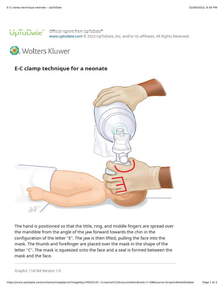 E-C Clamp Technique Neonate - UpToDate | PDF | Finance & Money ...