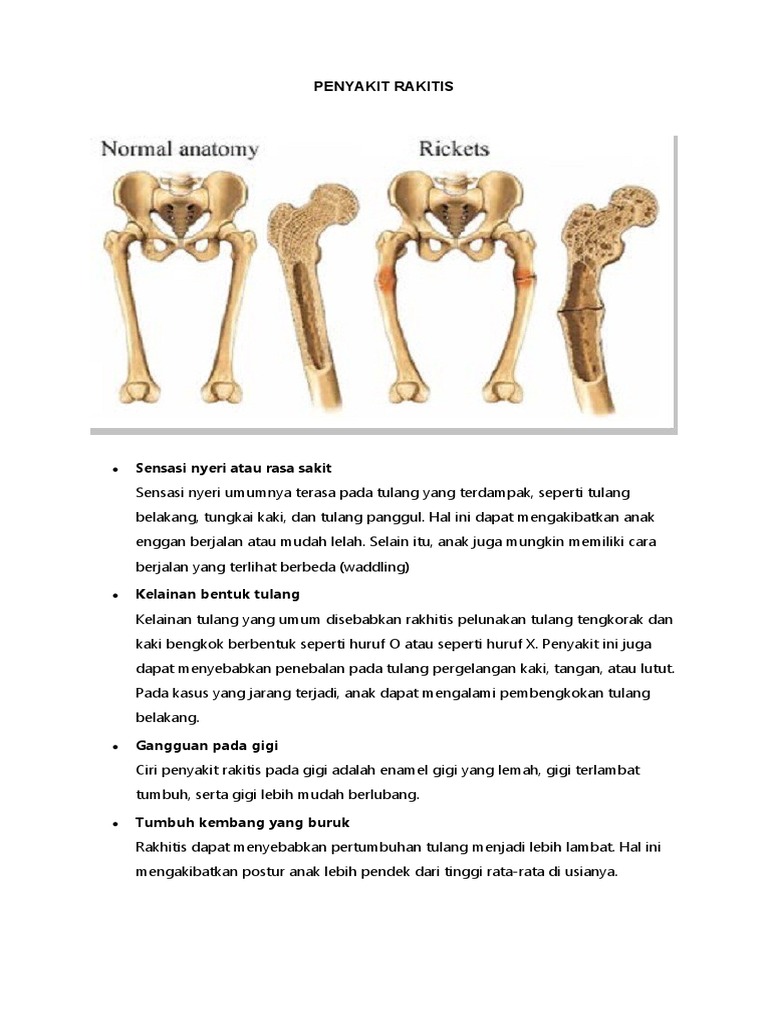 Penyakit Rakitis | PDF