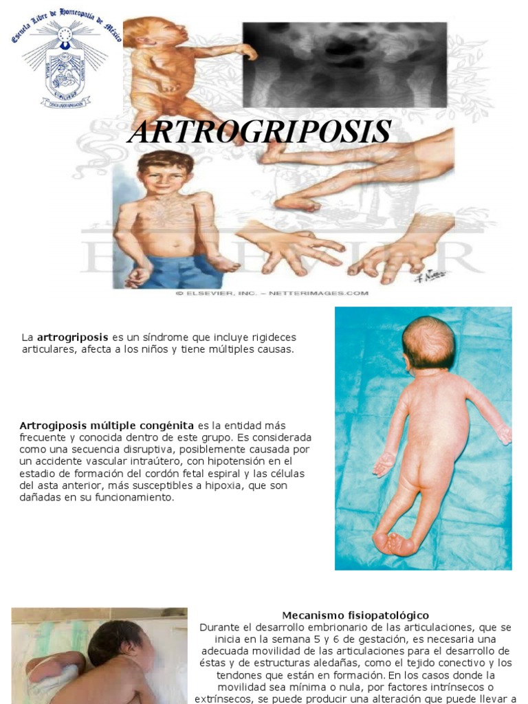 Artrogriposis Múltiple Congénita: Guía Clínica | PDF | Medicina CLINICA ...