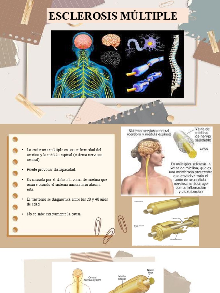 Esclerosis Múltiple | PDF | Esclerosis múltiple | Enfermedades y ...