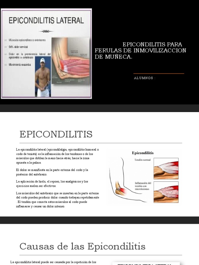 Epicondilitis lateral: causas, síntomas, diagnóstico, tratamiento y ...
