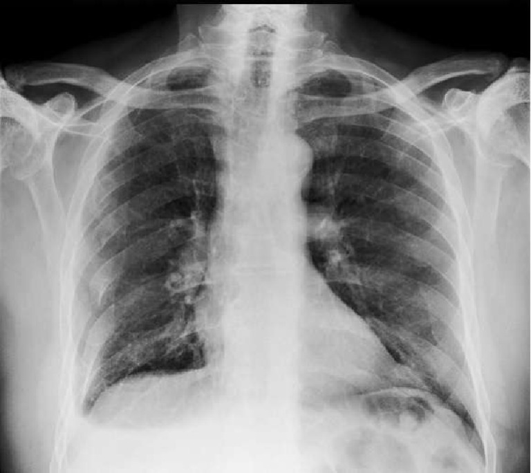 CespedesViorelLuis-RX AP Torax | PDF